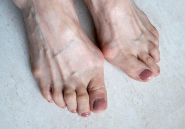 Hallux Valgus - Fusselastic steunzolen